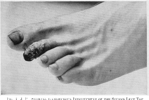 Figure 1 From Endarteritis Obliterans Obliterative Endarteritis Semantic Scholar