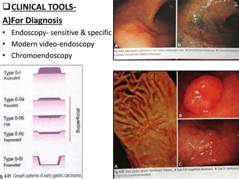 Gastric Cancer Pathology Seminar Pptx