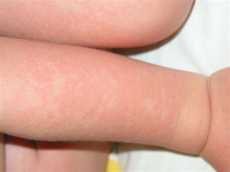 Fifths Disease Quarantine At Cindy Larson Blog