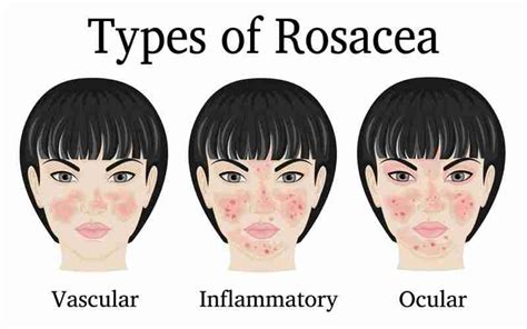What Causes Rosacea Infographics Archive