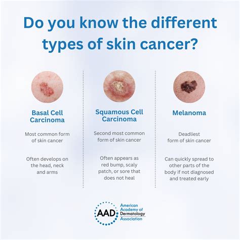 Types Of Skin Cancer How To Recognize The Different Types Of Skin