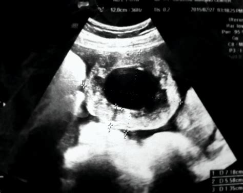 A Case Of Primary Ovarian Primitive Neuroectodermal Tumor Pmc