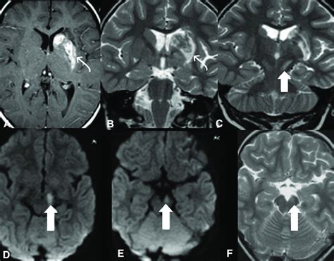 Left Transaxonal Degeneration Of The Nigrostriatal Pathway A And B An Download Scientific