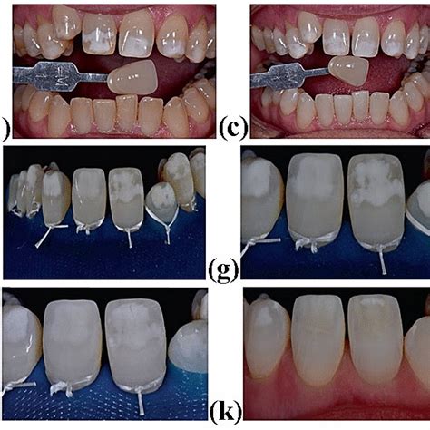 Resin Infiltration For Achromatic Enamel Dysplastic Spot Lesions A Download Scientific Diagram