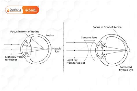 Defects Of Vision And Their Correction Class 10 Physics