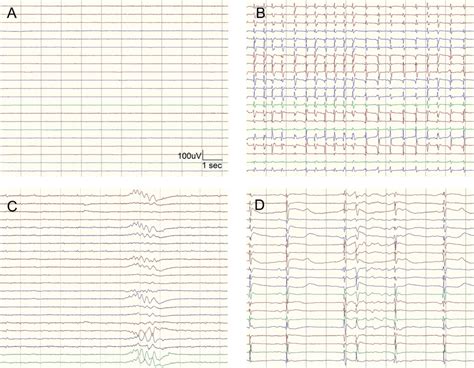 Highly Malignant Eeg Patterns Download Scientific Diagram