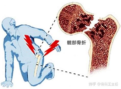 骨质减少和骨质疏松有什么区别哪个更严重 知乎