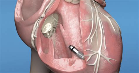 Medtronic Receives Ce Mark Approval For Next Generation Leadless Pacemakers