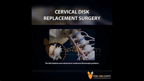 Cervical Disk Replacement Surgery Youtube