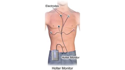 Holter Monitoring