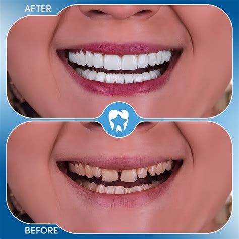 Composite Veneers In Turkey Cost And Packages In 2025