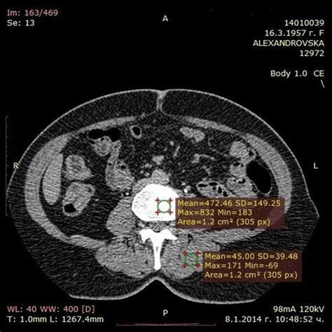 Evaluation Of Axial Vertebral Rotation In 2d Images A Cobb Method Download Scientific Diagram