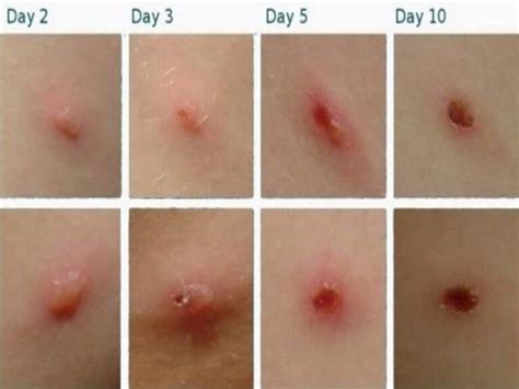 Understanding The Stages Of Chickenpox Symptoms Progression And