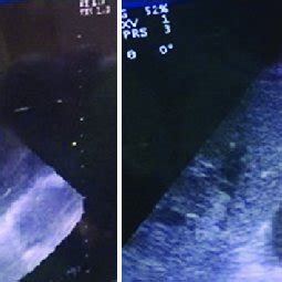 A Echo Showing Dilated IVC And RA B Dilated RA And RV IVC Download Scientific Diagram