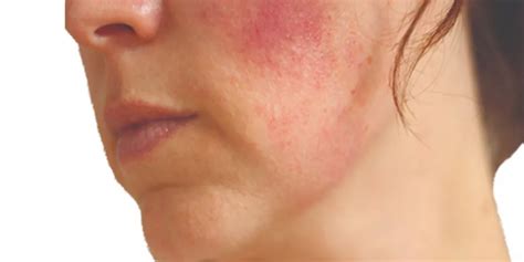 ما هو التهاب الجلد الدهني وكيف يمكن علاجه؟ الطبي