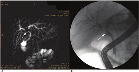 Mrcp A And Ercp B Findings Showing A Dominant Stricture