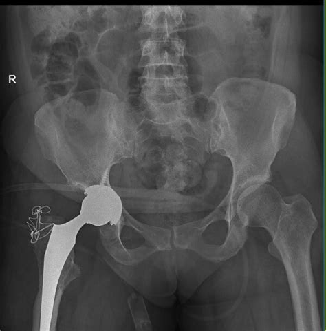 Radiograph After Revision Hip Surgery Download Scientific Diagram