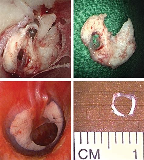 Tympanosclerosis Surgery