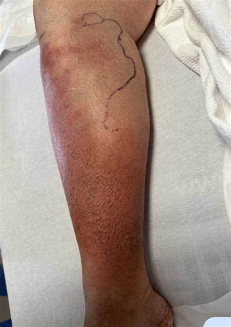 Osteomyelitis Masquerading As Cellulitis A Case Report Pmc