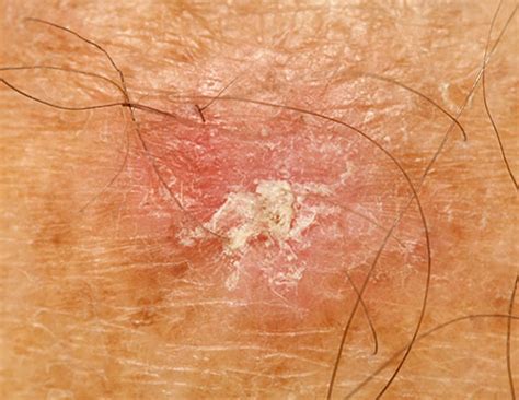 Are Actinic Keratosis Benign