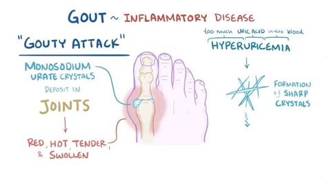 Anti Gout Diet Foods To Eat Foods To Avoid And More Osmosis