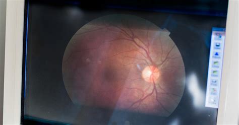 Horrific Problems Caused By Having A Torn Retina