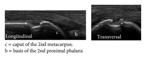 Erosion In The 2nd Mcp Joint From Dorsal Download Scientific Diagram