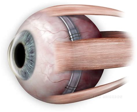 Scleral Buckle Surgery Retina Center Of San Diego