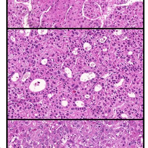 Hcc Gross Subtypes Massive Form Top Nodular Form Bottom Left And