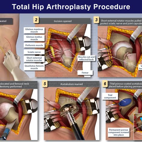 Medical Legal Exhibits Legal Animations And Trial Graphics Tria