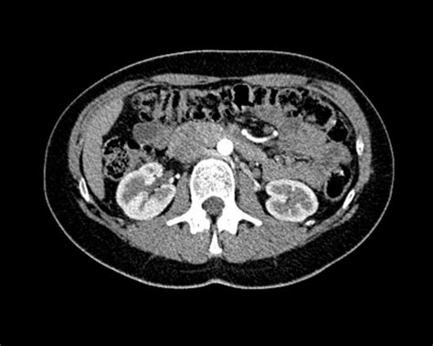 Ct Scan Urogram At Kevin Tejeda Blog