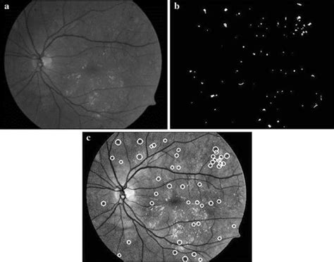 Hemorrhages Detection Results Based On K Means Clustering And Svm A Download Scientific