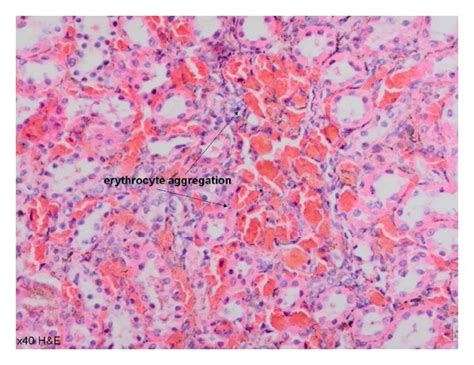 Erythrocyte Aggregation In Glomerular Field And Interstitium In Abs