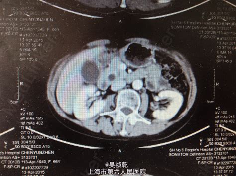 特殊的壶腹部癌一例