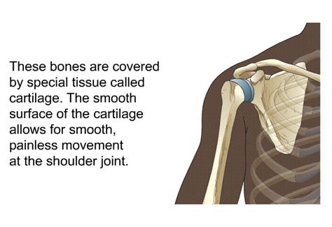 Shoulder Replacement Preventing Post Op Complications