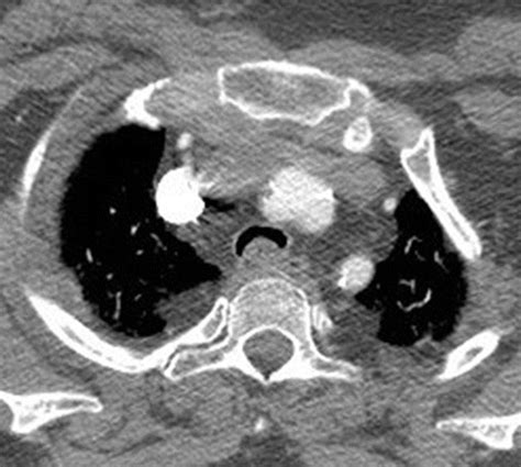 Tracheobronchomalacia And Excessive Dynamic Airway Collapse Current
