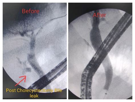 Ercp Endoscopy Advancedendoscopy Drrv Krishna Kishore