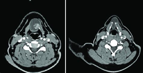 Primary Papillary Carcinoma Of The Thyroglossal Duct Cyst In The Ct