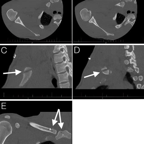 Ct Scan Showing Right Posterior Sc Joint Dislocation With The Medial Download Scientific