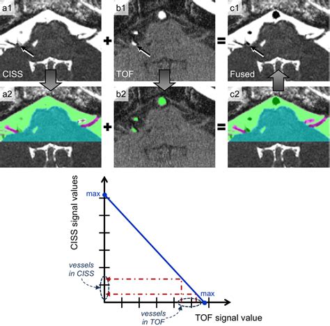 Innovative Fusion Process Fused Slice Image C1 In Hemifacial Spasm