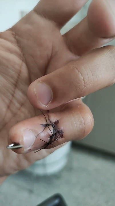 Cirurgia Com Inserção Do Fio De Kirschner 5° Dedo Mindinho Youtube