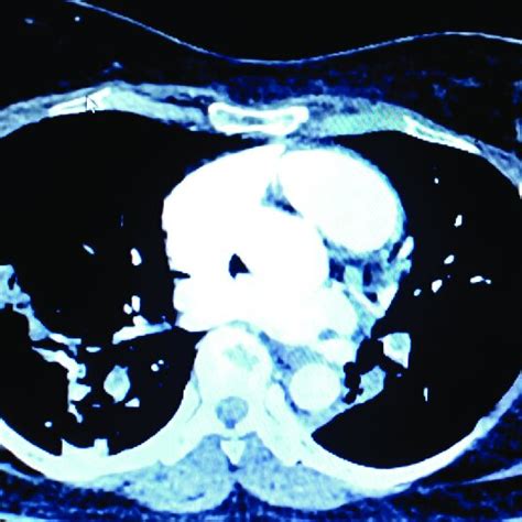 Filling Defects In Bi Lateral Segmental Pulmonary Arteries Ctpa Image Download Scientific Diagram