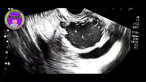 Intracavitary Fibroid Ultrasound Youtube