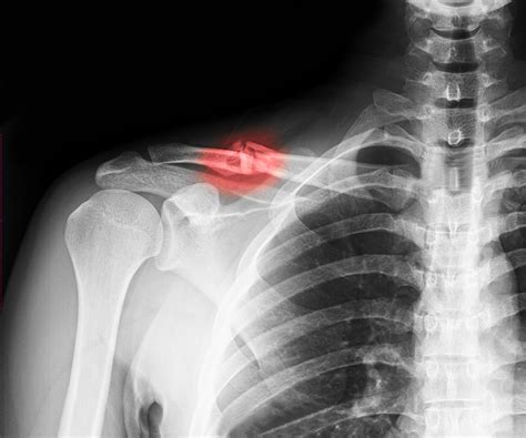 Broken Collarbones Why Clavicle Fractures Are Now Repaired