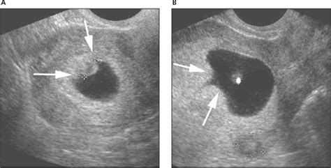 Chorionic Plate Ultrasound