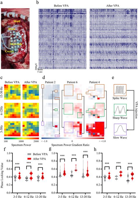 frequency spectrum power analysis for ecog signals a intra operation download scientific