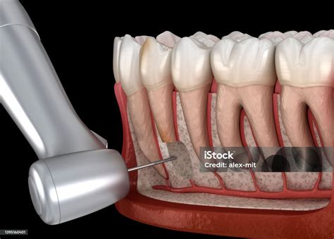 치아 방광 절제술 수술 골막염 후 회복 치과용 3d 일러스트레이션 건강관리와 의술에 대한 스톡 사진 및 기타 이미지 건강관리와 의술 경련 꼭대기 Istock