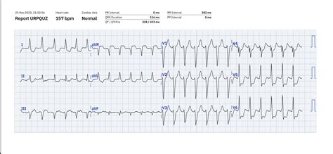 Atrial Fibrillation Rvr Ecg