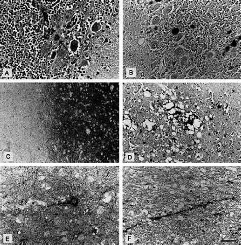 A Kuru Like Plaque Arrow Is The Only Form Of Prp Sc Deposition