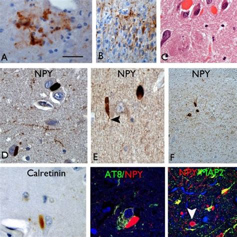 Dentate Gyrus Alterations In Hippocampal Sclerosis In Epilepsy Hse